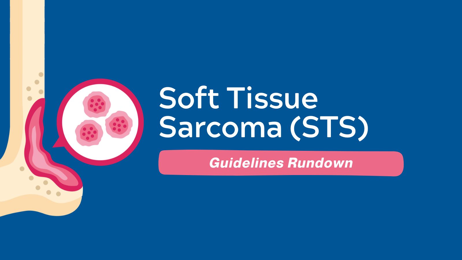 Soft Tissue Sarcoma - Guidelines Rundown - Guideline Central