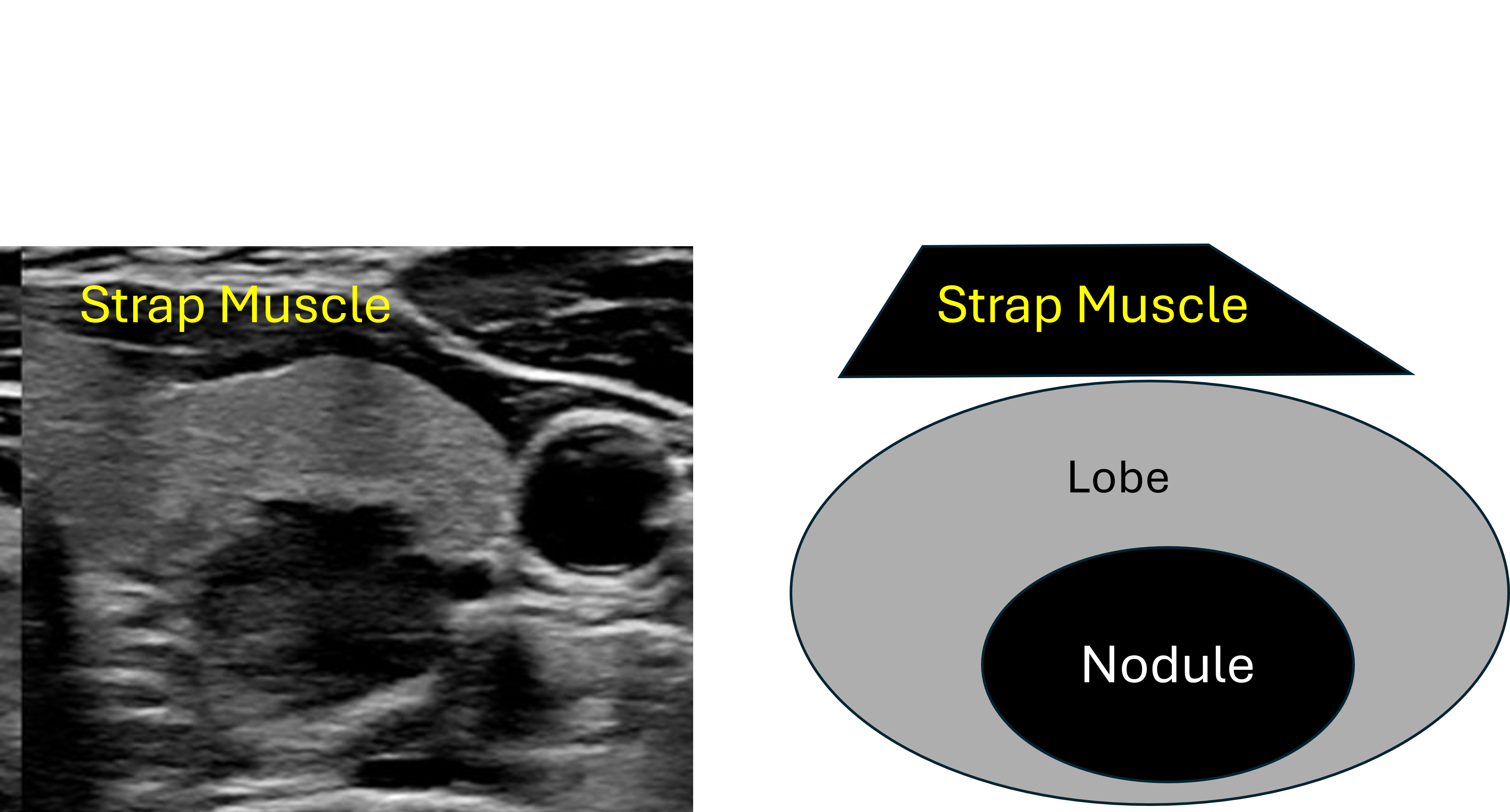 ATA 2026 Sonographic Classification and Assessment of Thyroid Nodules ...