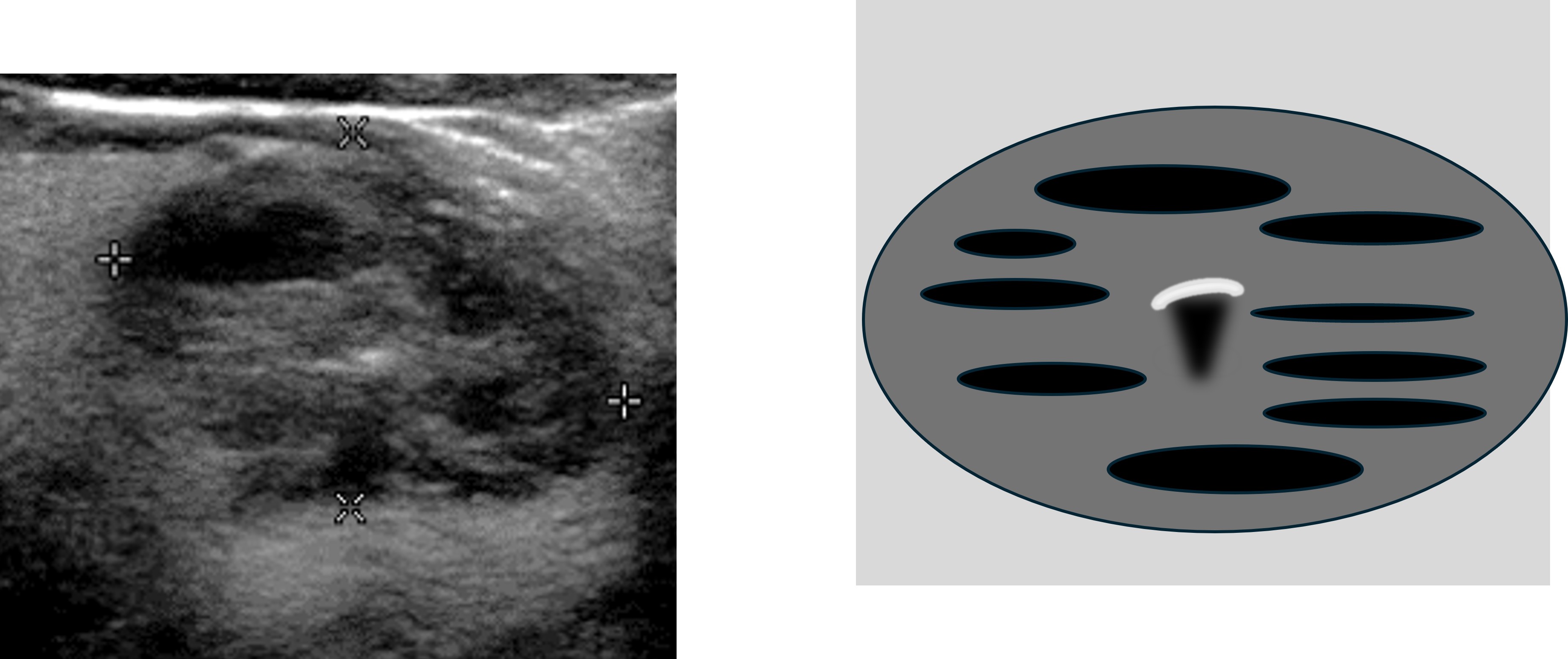 ATA 2026 Sonographic Classification and Assessment of Thyroid Nodules ...