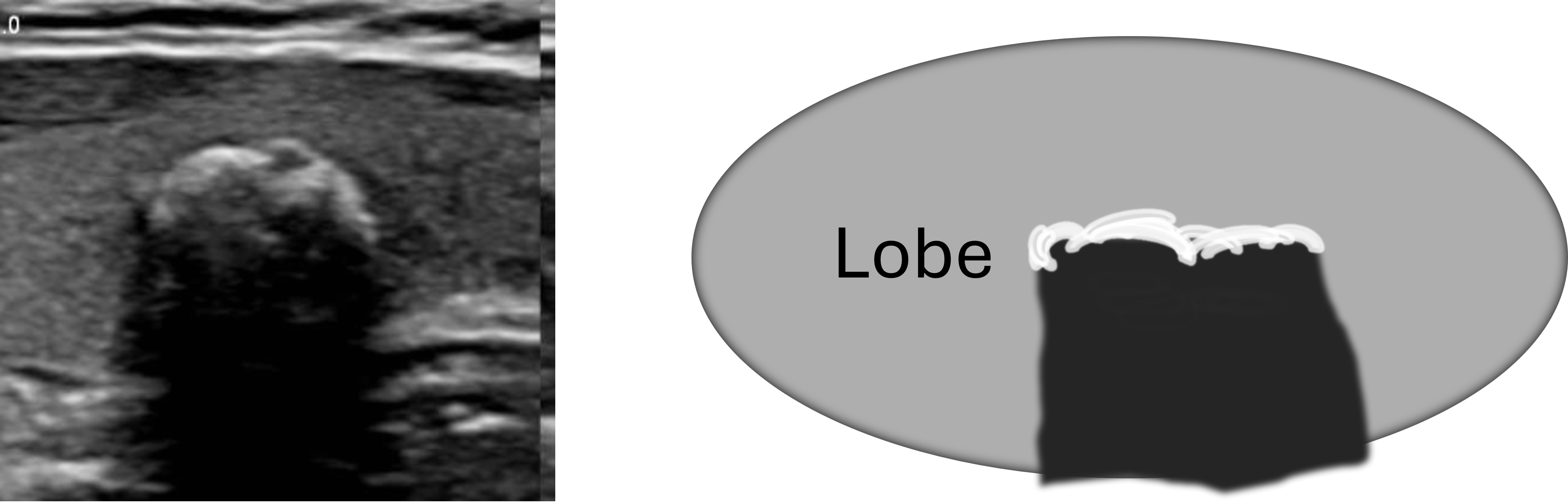 ATA 2026 Sonographic Classification and Assessment of Thyroid Nodules ...