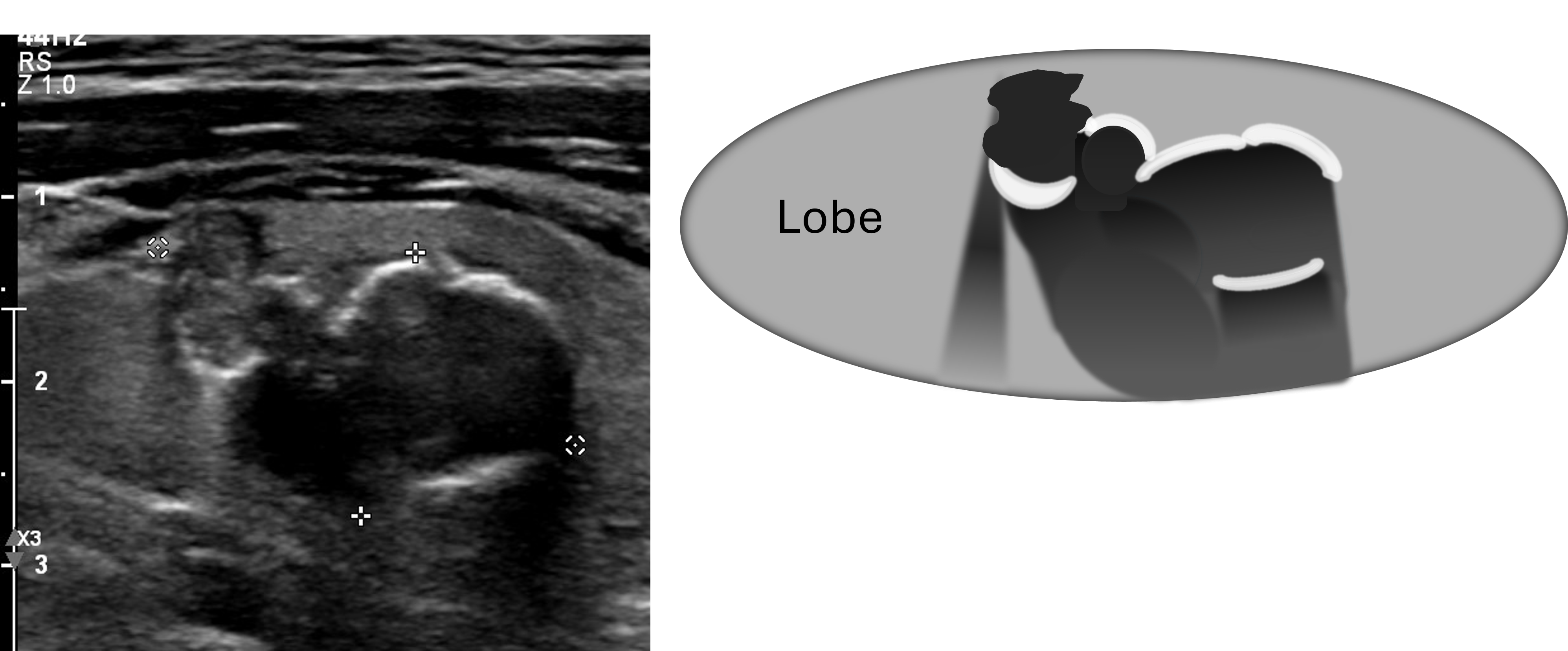 ATA 2026 Sonographic Classification and Assessment of Thyroid Nodules ...