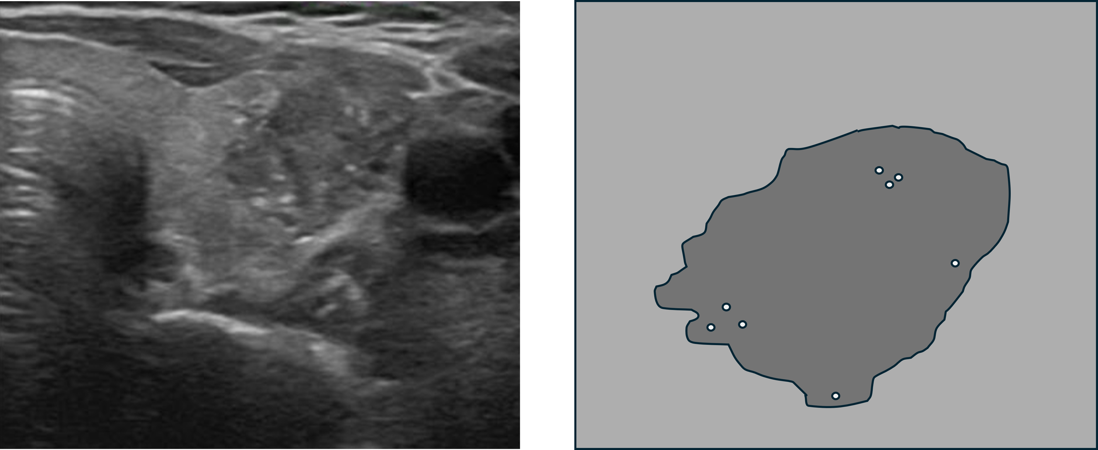 ATA 2026 Sonographic Classification and Assessment of Thyroid Nodules ...