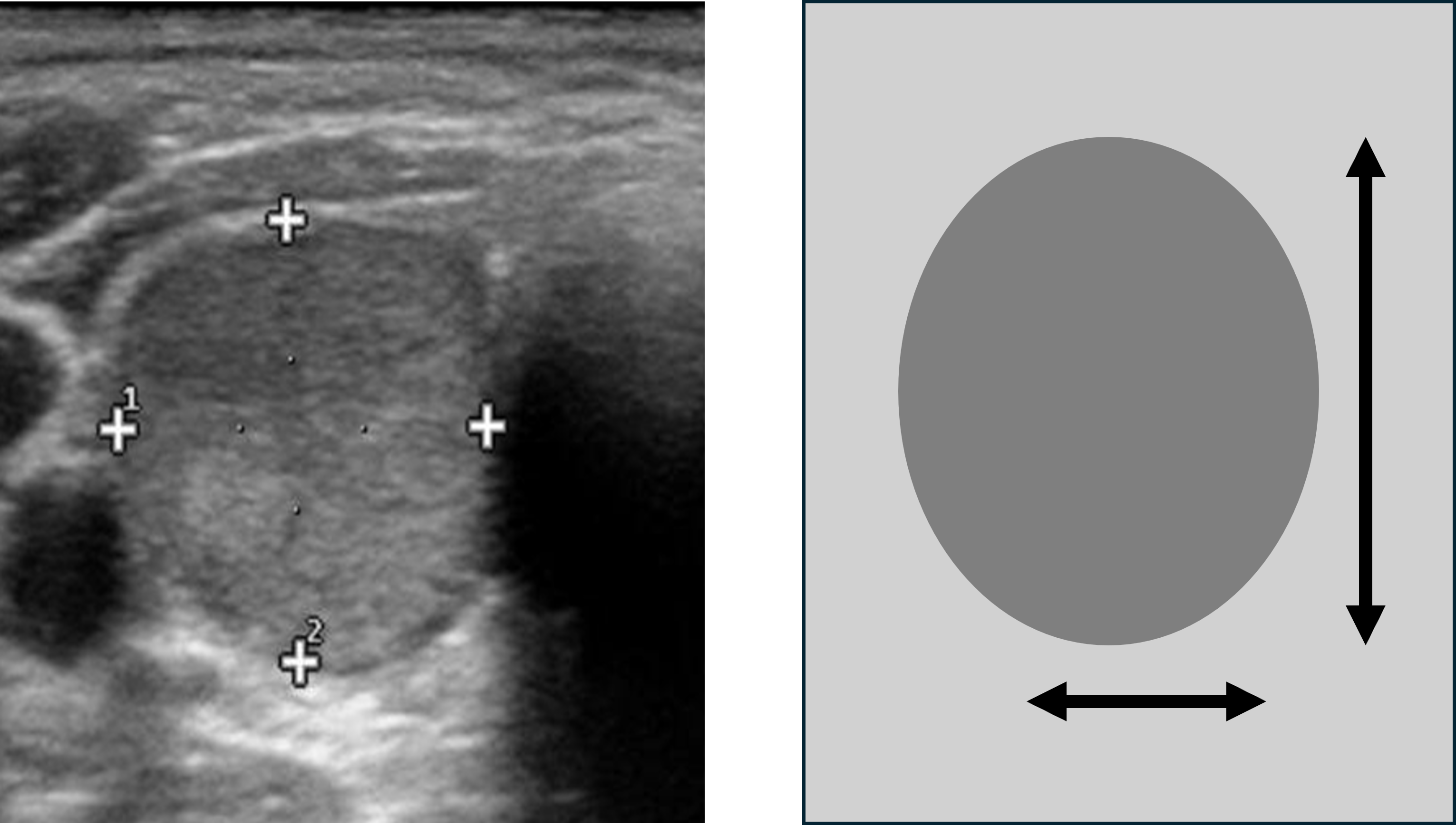 ATA 2026 Sonographic Classification and Assessment of Thyroid Nodules ...