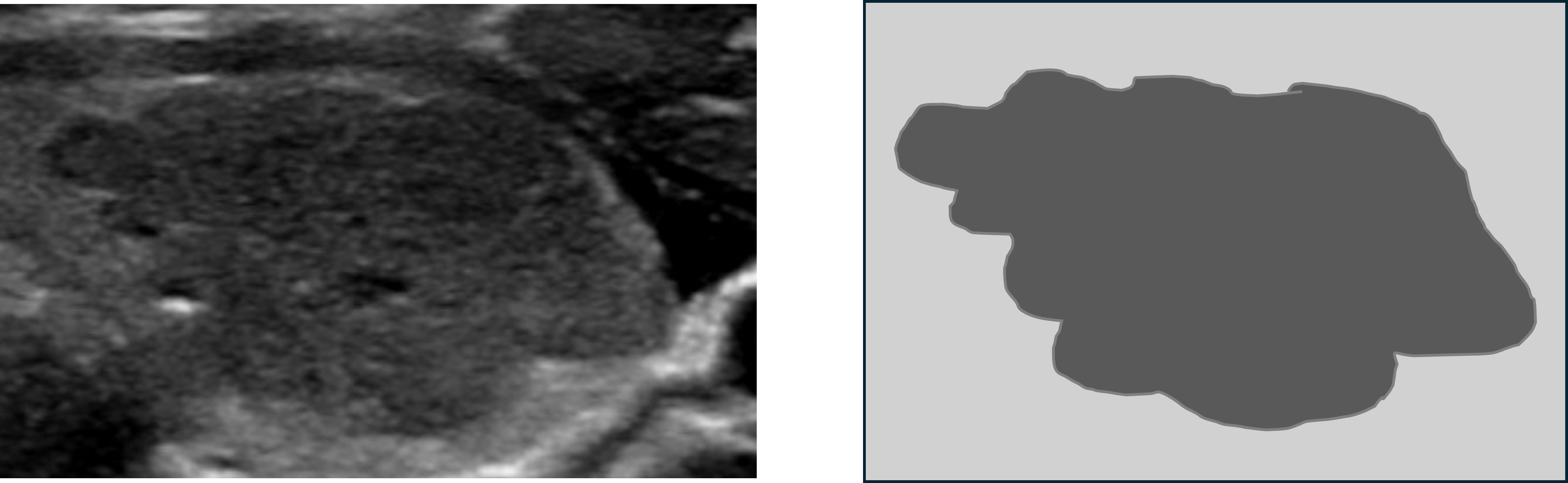 ATA 2026 Sonographic Classification and Assessment of Thyroid Nodules ...