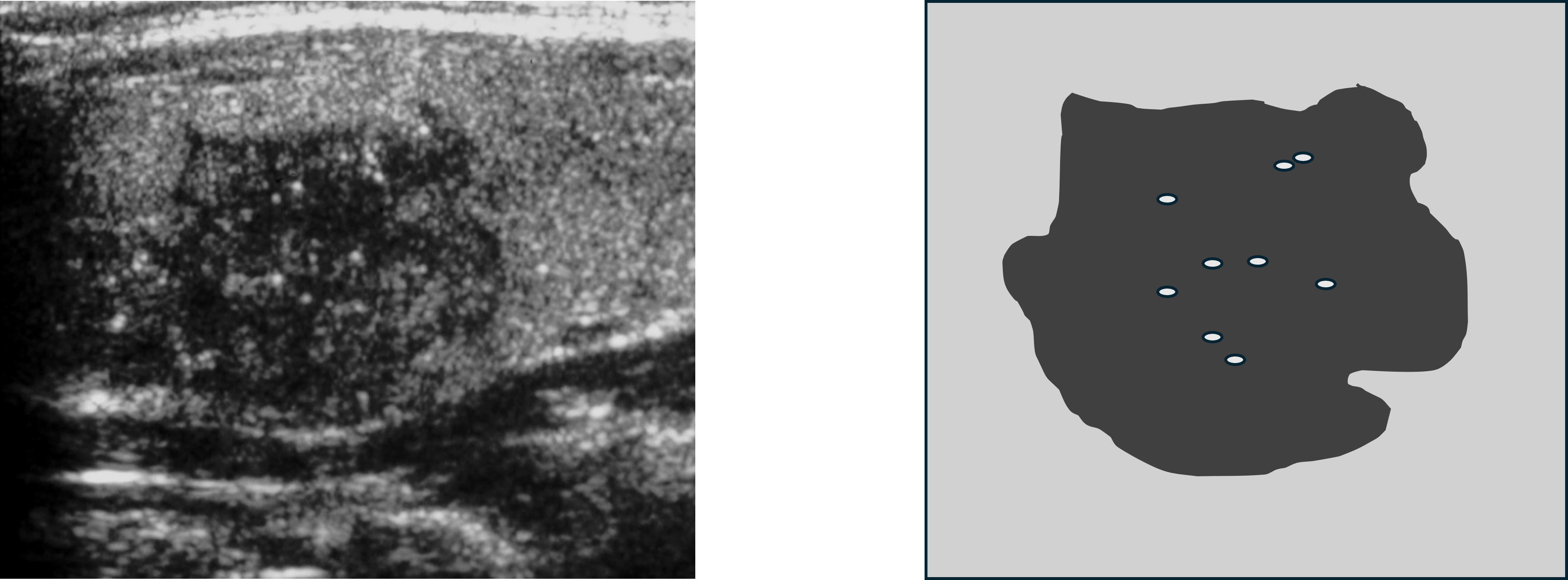 ATA 2026 Sonographic Classification and Assessment of Thyroid Nodules ...