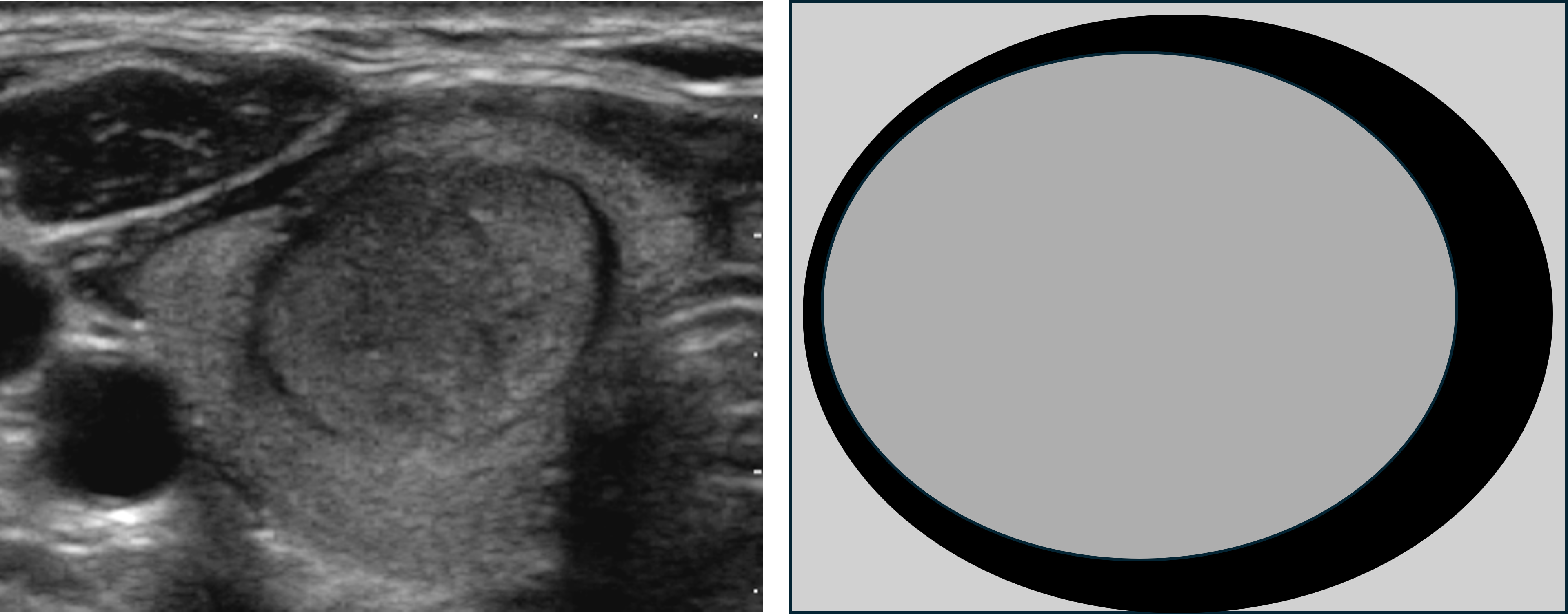 ATA 2026 Sonographic Classification and Assessment of Thyroid Nodules ...