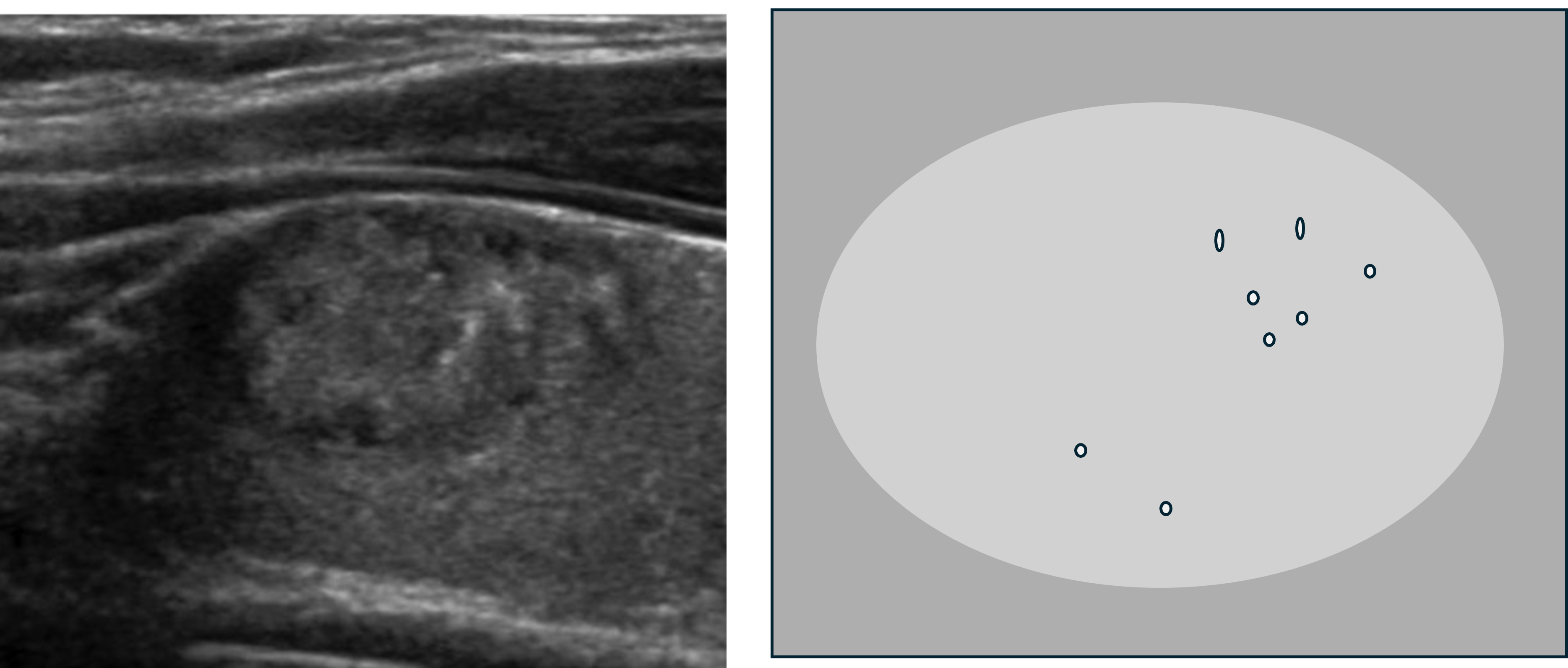 ATA 2026 Sonographic Classification and Assessment of Thyroid Nodules ...