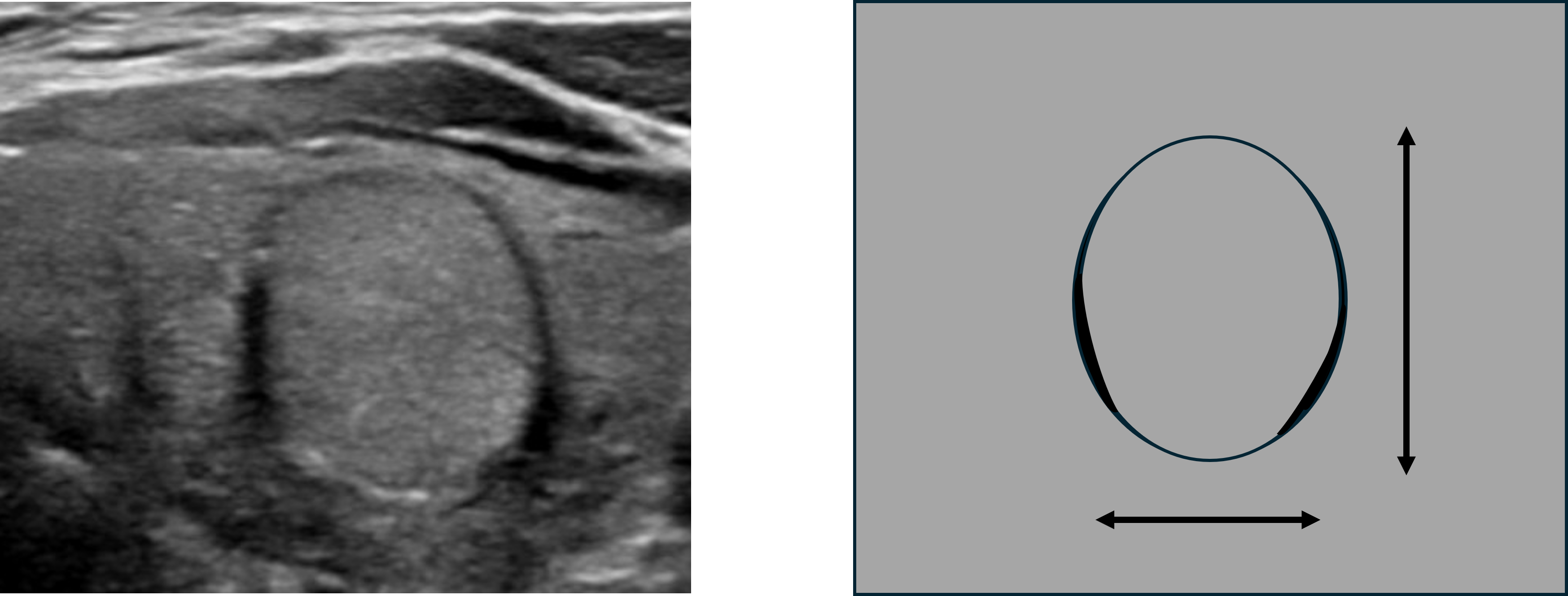 ATA 2026 Sonographic Classification and Assessment of Thyroid Nodules ...