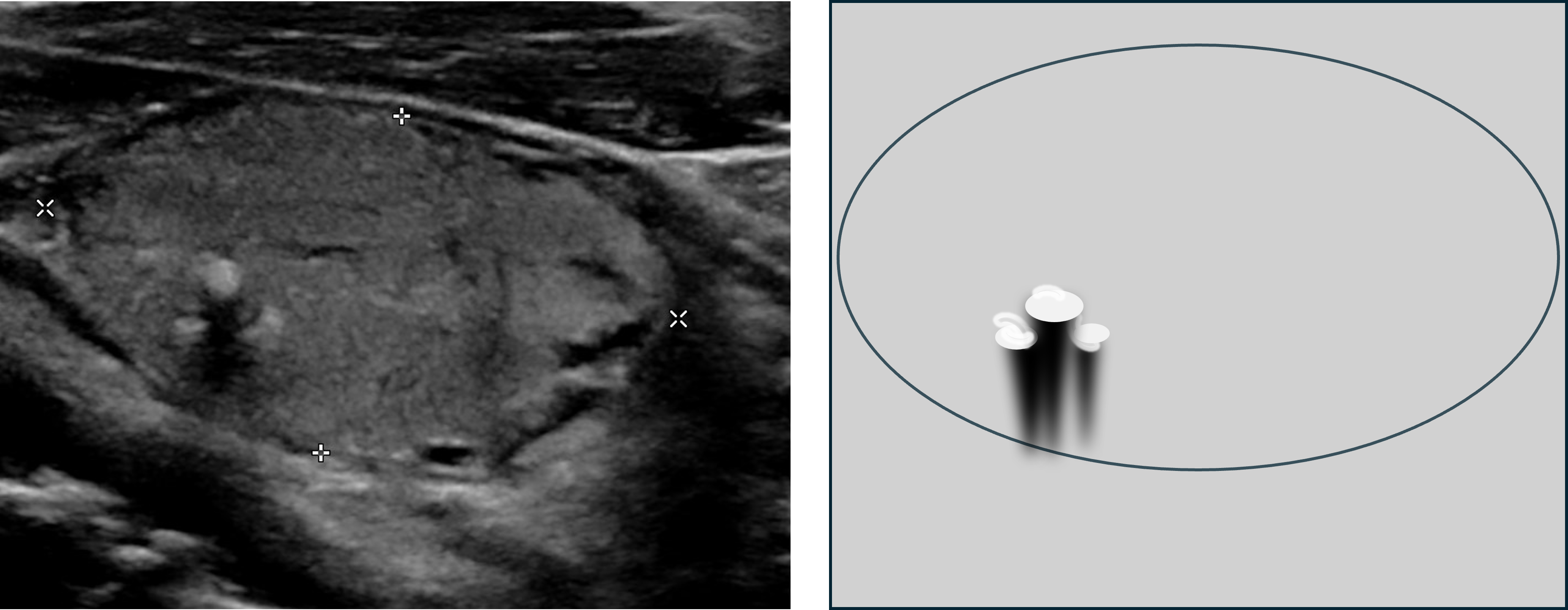 ATA 2026 Sonographic Classification and Assessment of Thyroid Nodules ...