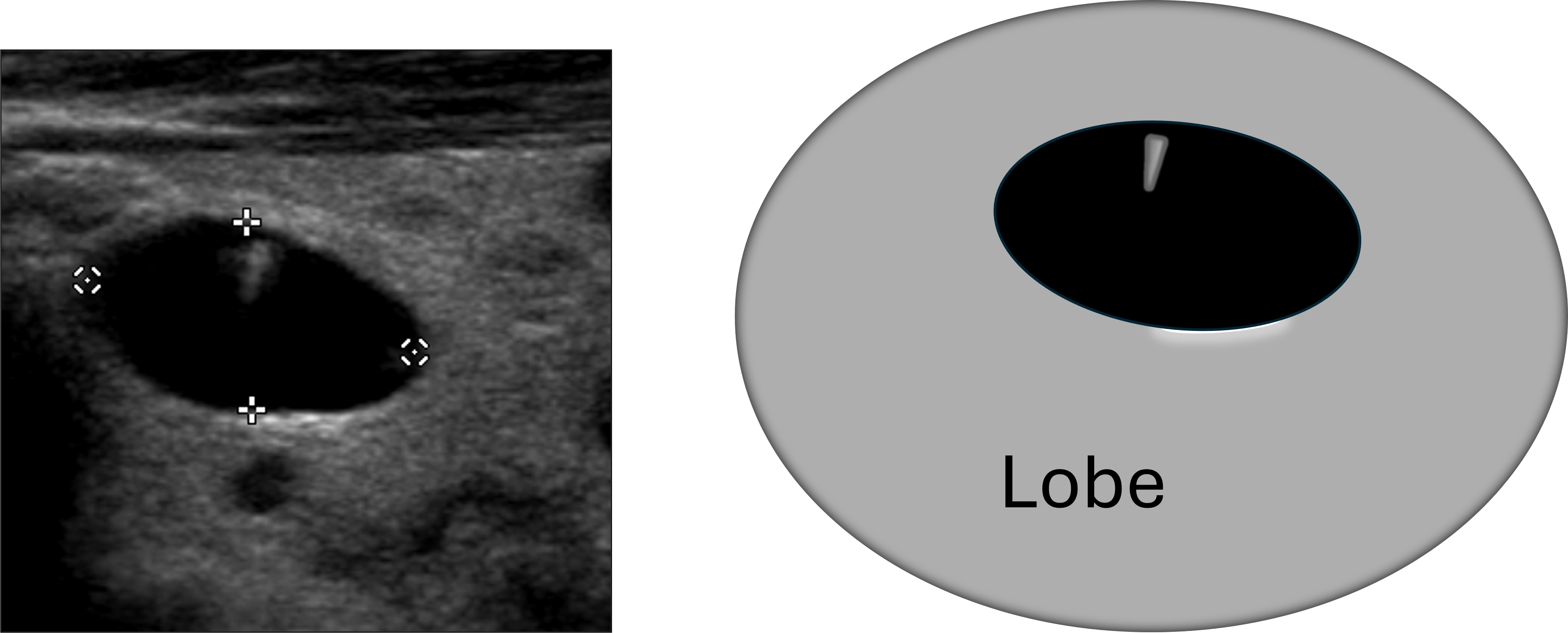 ATA 2026 Sonographic Classification and Assessment of Thyroid Nodules ...