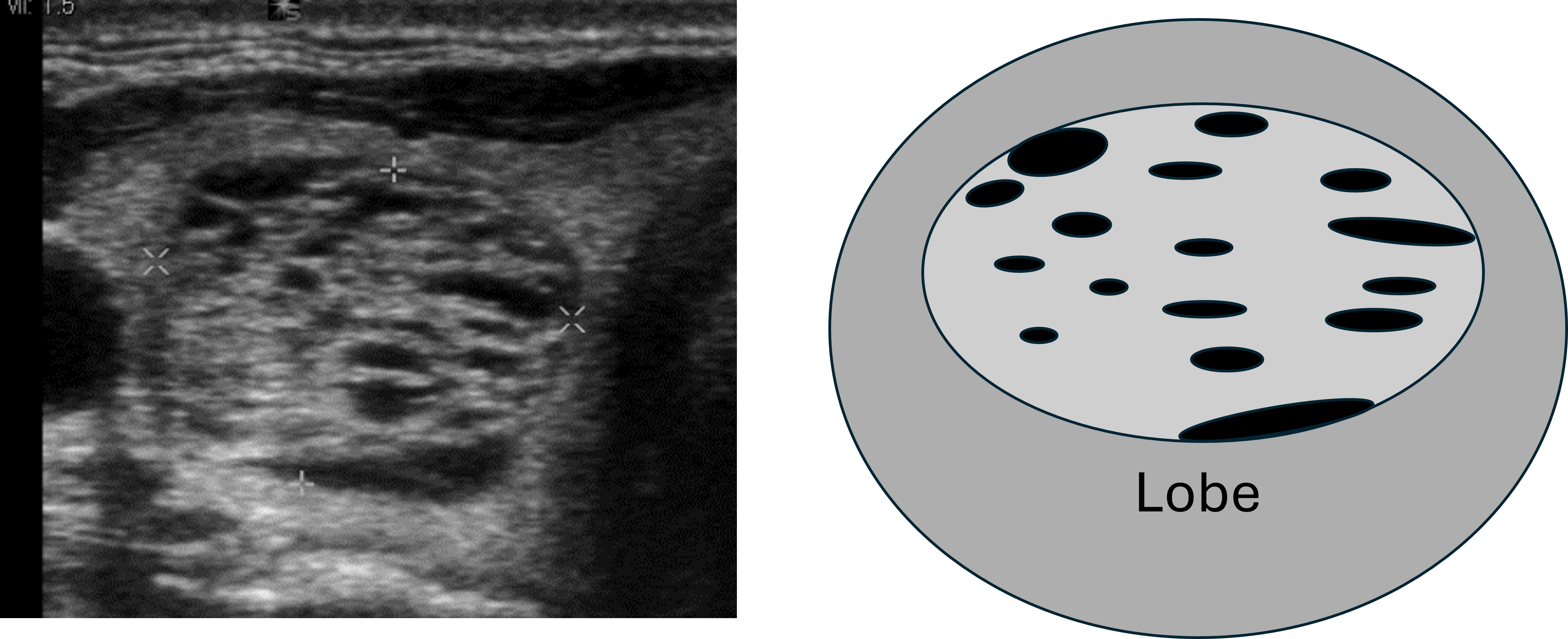 ATA 2026 Sonographic Classification and Assessment of Thyroid Nodules ...