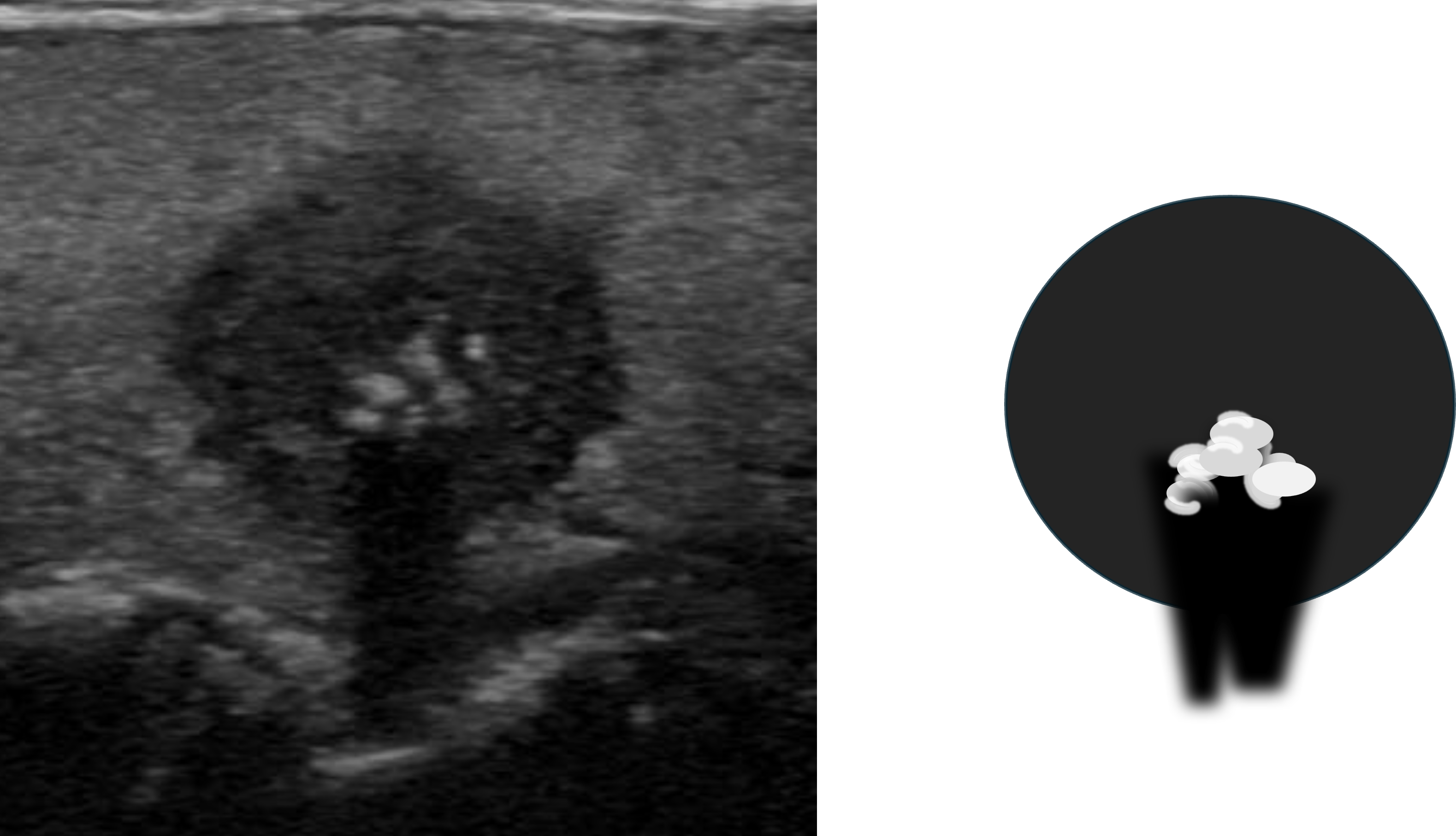 ATA 2026 Sonographic Classification and Assessment of Thyroid Nodules ...