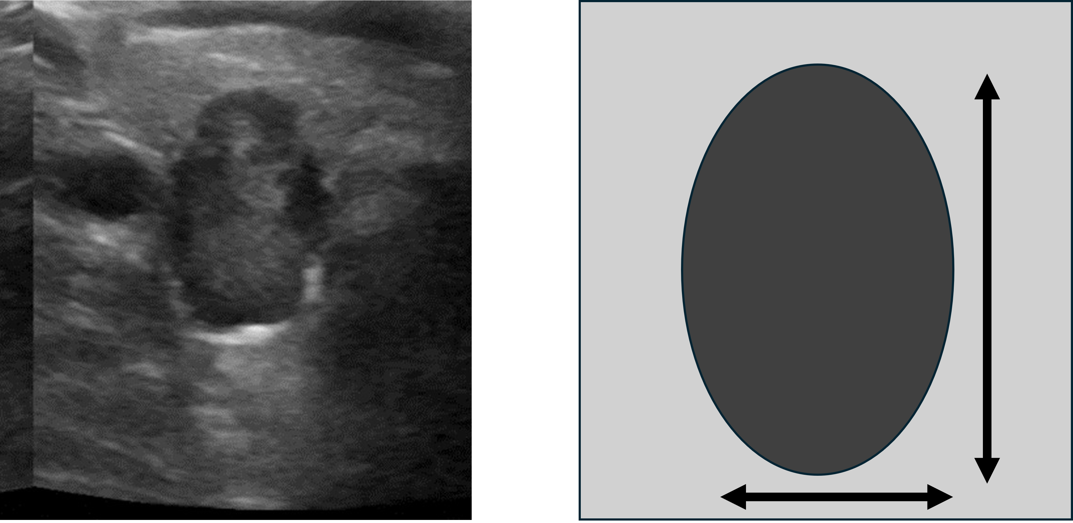 ATA 2026 Sonographic Classification and Assessment of Thyroid Nodules ...